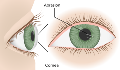 Erosio corneae und Keratitis - E-Learning mit Lecturio