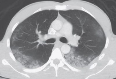 Bildgebung der Lunge: CT, MRT, Röntgen | Lecturio