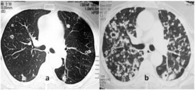 Bildgebung der Lunge: CT, MRT, Röntgen | Lecturio