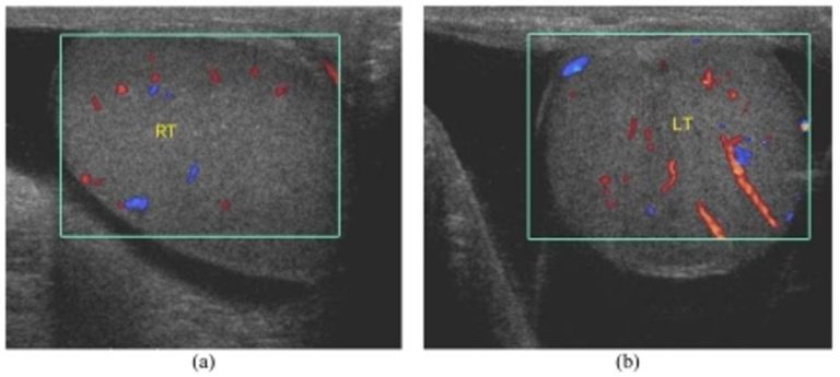Skrotale Bildgebung: Ultraschall/MRT | Lecturio