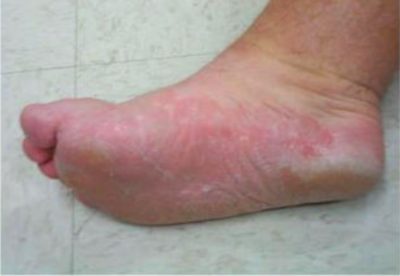 Tinea-Infektionen/Dermatophyten: Überblick | Lecturio