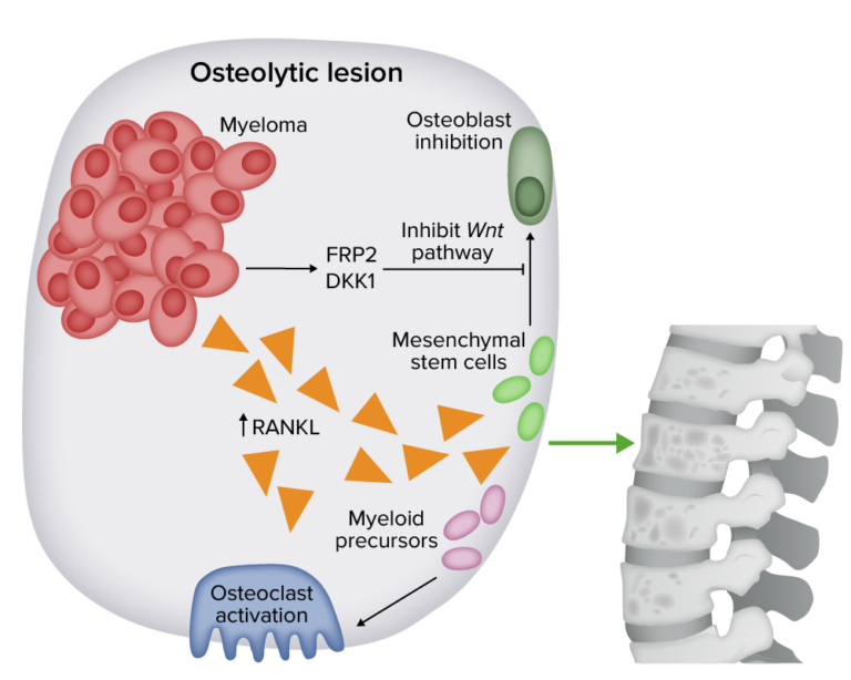 Multiples Myelom - E-Learning mit Lecturio