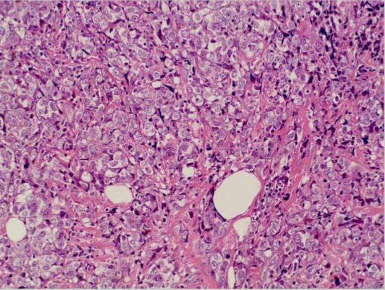Mammakarzinom (Brustkrebs) - E-Learning mit Lecturio