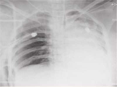 Instabiler Thorax: Definition & Behandlung | Lecturio