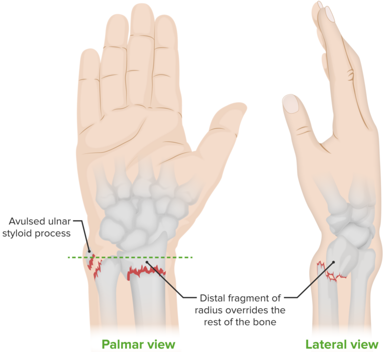 Osteoporose - E-Learning mit Lecturio
