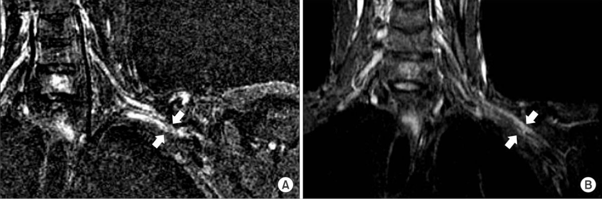 Thoracic-outlet-Syndrom - E-Learning mit Lecturio