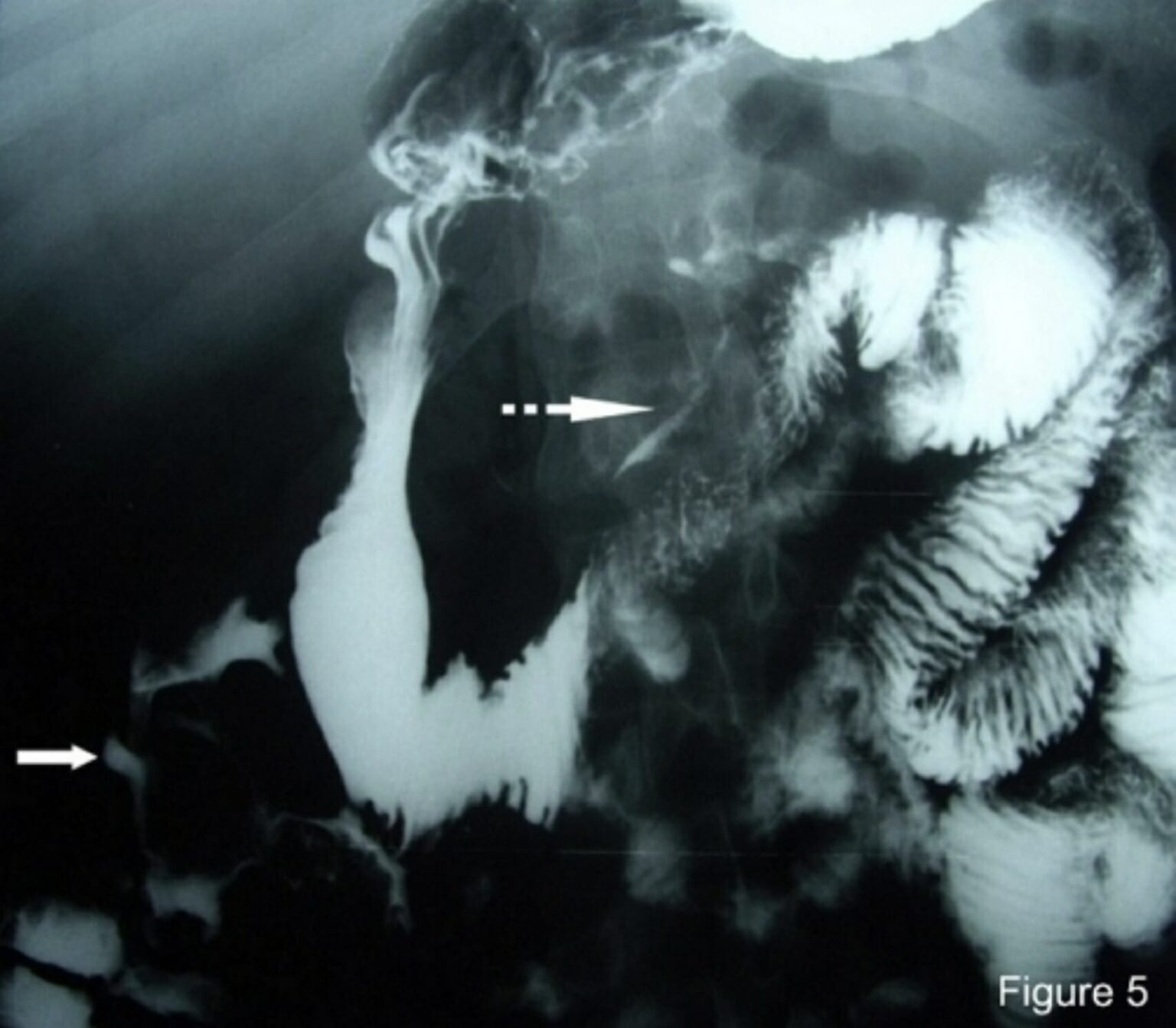 Bildgebung des Darms: Röntgen, Ultraschall, CT | Lecturio