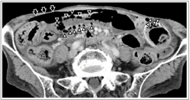 Bildgebung des Darms: Röntgen, Ultraschall, CT | Lecturio