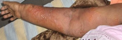 Erysipel - E-Learning mit Lecturio