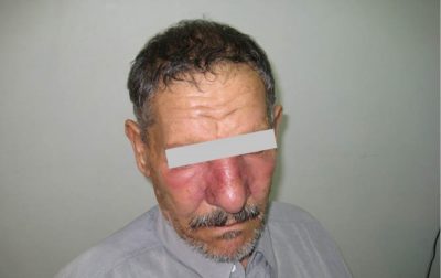 Erysipel - E-Learning mit Lecturio