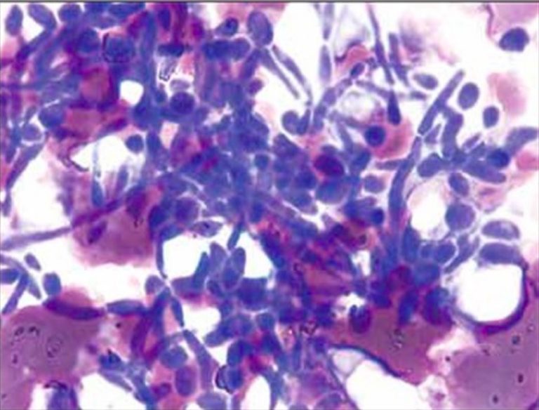 Entzündungen von Vagina und Vulva: Kolpitis und Vulvitis - E-Learning ...