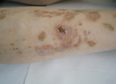 Exantheme: generalisiert vs lokalisiert (+Bilder) | Lecturio