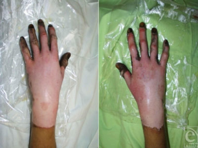 Verbrennungen: Klassifikation, Arten | Lecturio