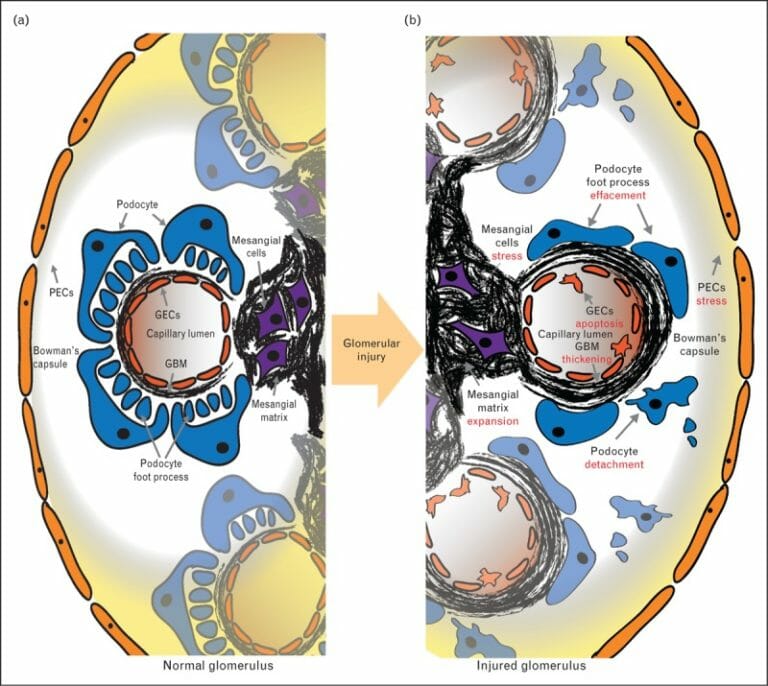 Nephrotisches Syndrom im Kindesalter - E-Learning mit Lecturio