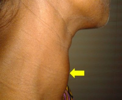 Morbus Basedow (Graves’ Disease) - E-Learning mit Lecturio