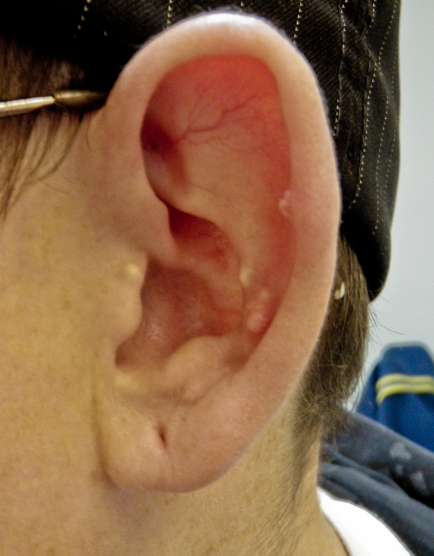 Gicht (Hyperurikämie) - E-Learning mit Lecturio