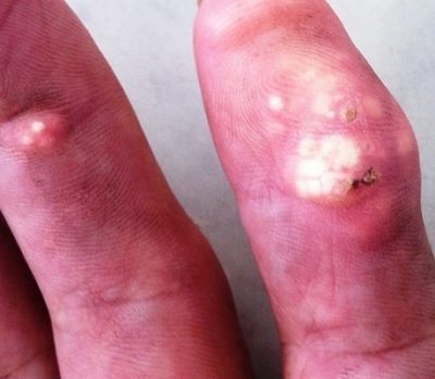 Gicht (Hyperurikämie) - E-Learning mit Lecturio