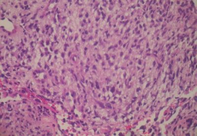 Uterus-Leiomyom und Leiomyosarkom - E-Learning mit Lecturio