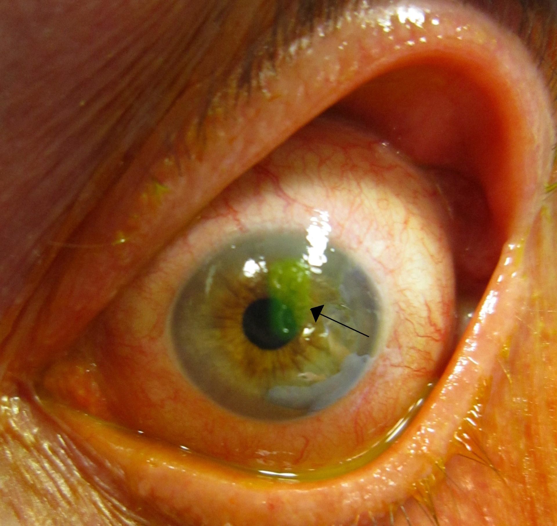 Erosio corneae und Keratitis - E-Learning mit Lecturio