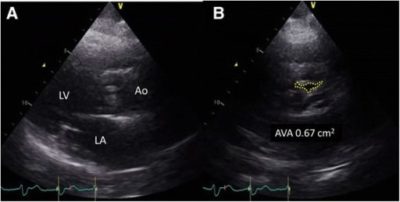Aortenklappenstenose - E-Learning mit Lecturio