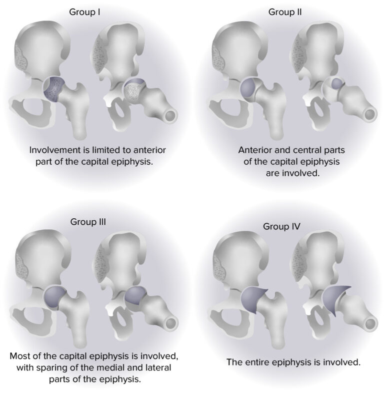 Morbus Perthes - E-Learning mit Lecturio