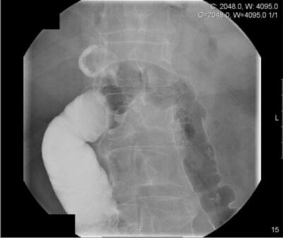 Bildgebung des Darms: Röntgen, Ultraschall, CT | Lecturio