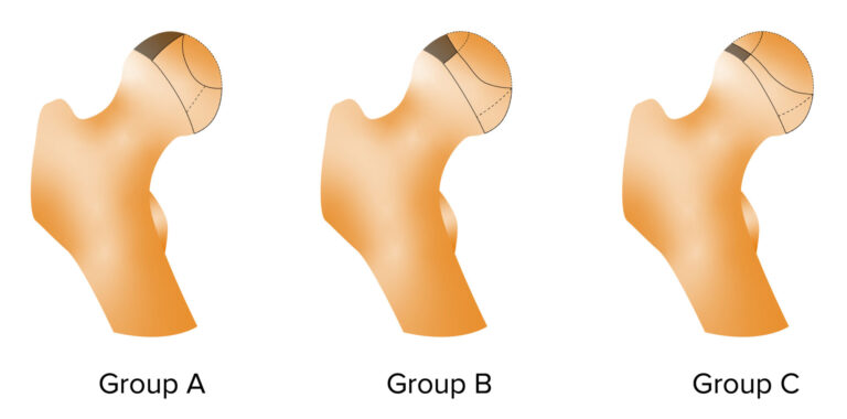 Morbus Perthes - E-Learning mit Lecturio
