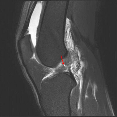 Kniebandverletzungen - E-Learning mit Lecturio