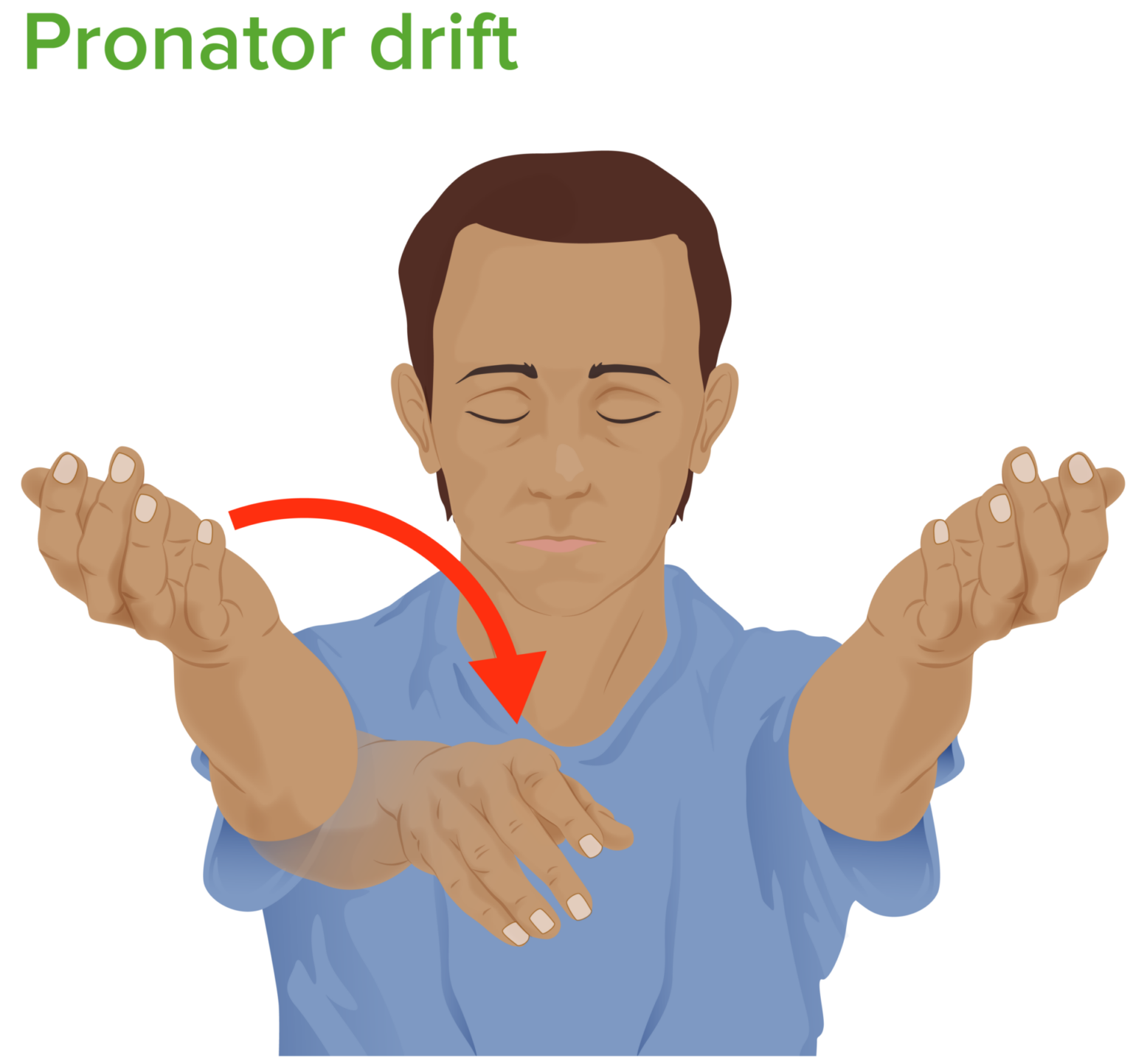 Läsionen der oberen und unteren Motoneurone - E-Learning mit Lecturio