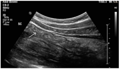 Bildgebung des Darms: Röntgen, Ultraschall, CT | Lecturio
