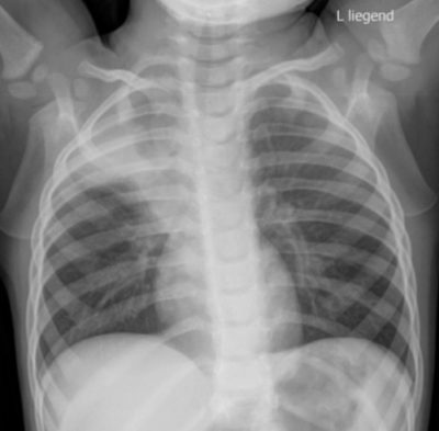 Atelektase - E-Learning mit Lecturio