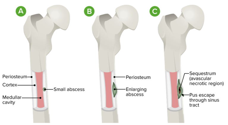 Osteomyelitis - E-Learning mit Lecturio