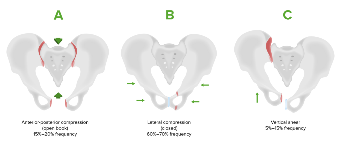 Beckenfrakturen - E-Learning mit Lecturio