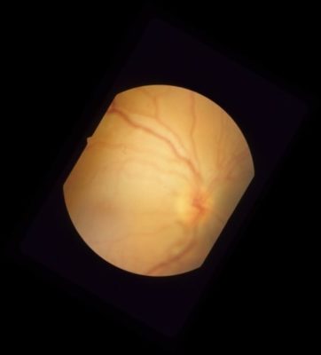 Netzhautablösung (Amotio/Ablatio retinae) - E-Learning mit Lecturio