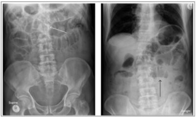 Bildgebung des Darms: Röntgen, Ultraschall, CT | Lecturio