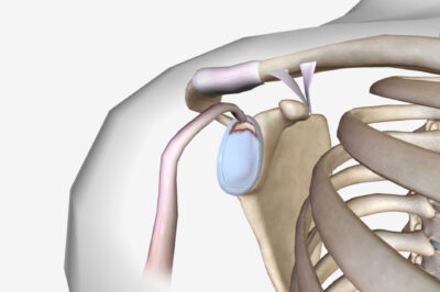 Schulterschmerzen: SLAP-Läsion u.a. Ursachen | Lecturio