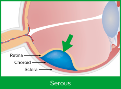 Netzhautablösung (Amotio/Ablatio retinae) - E-Learning mit Lecturio