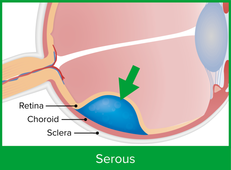 Netzhautablösung (Amotio/Ablatio retinae) - E-Learning mit Lecturio