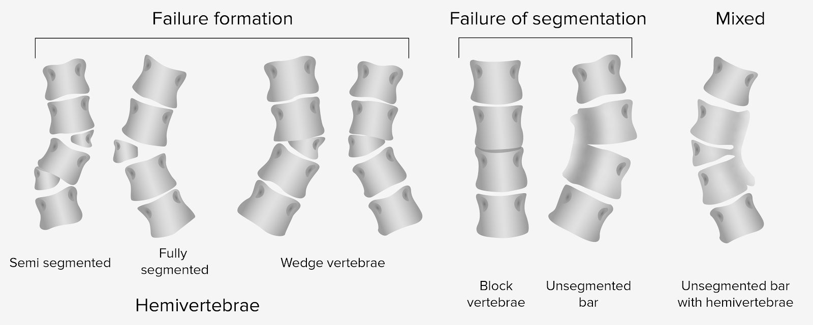 Skoliose - E-Learning mit Lecturio