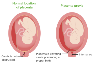 Plazenta-Pathologien - E-Learning mit Lecturio