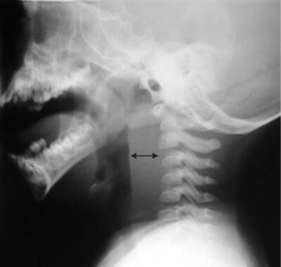 Anatomia Do Abscesso Retrofaringeo