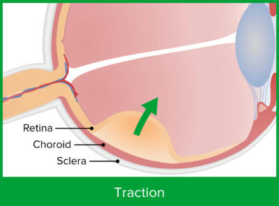 Netzhautablösung (Amotio/Ablatio retinae) - E-Learning mit Lecturio