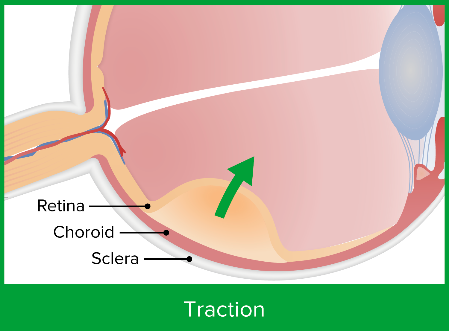 Netzhautablösung (Amotio/Ablatio retinae) - E-Learning mit Lecturio