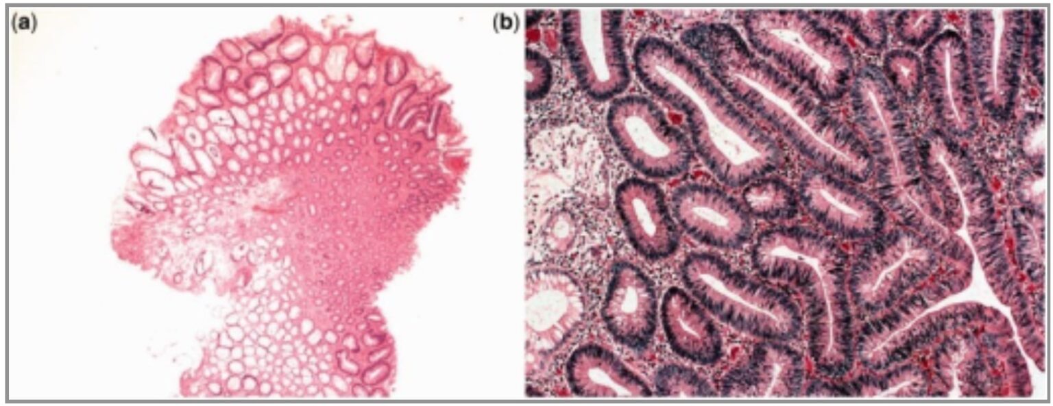 Dickdarmpolypen - E-Learning mit Lecturio