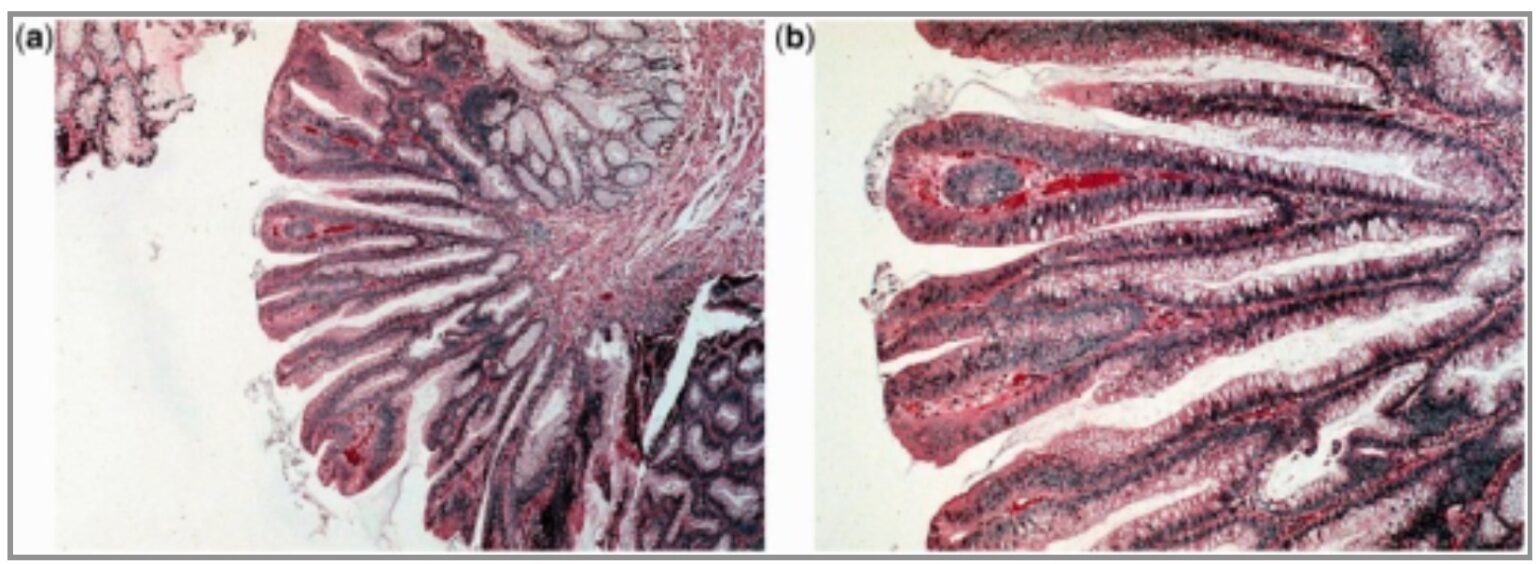 Dickdarmpolypen - E-Learning mit Lecturio