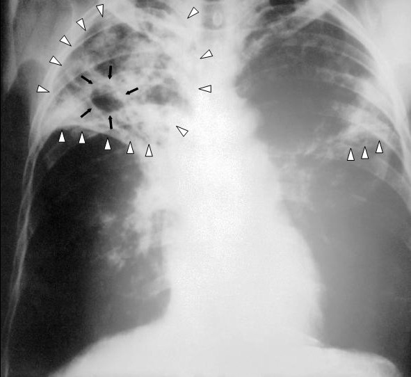 Pleuritis - E-Learning mit Lecturio