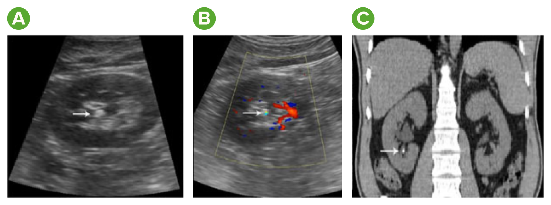 Proteus: Klassifikation & Therapie | Lecturio